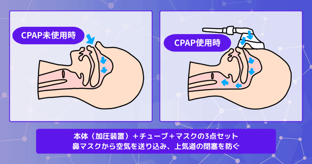 CPAP（シーパップ）療法 | 【公式】たかはし内科循環器科医院