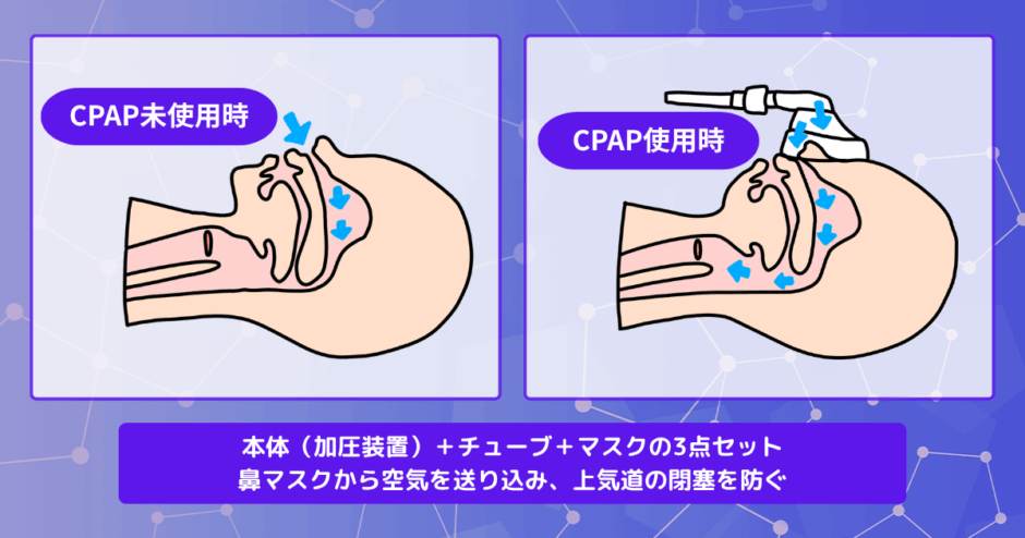 CPAP（シーパップ）とは？睡眠時無呼吸症候群の治療法や具体的な使い方、費用目安を徹底解説 | ミライメディカルクリニック｜全国対応オンライン ...